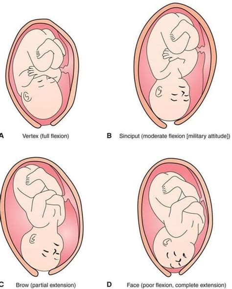 Medical 🤰 Fetal Presentations During Labor Understanding The