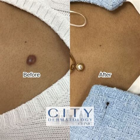 Keloid Scar Removal In London From £295 Same Day