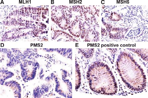 Immunohistochemical Staining Of Mlh1 Pms2 Msh2 And Msh6 Proteins In