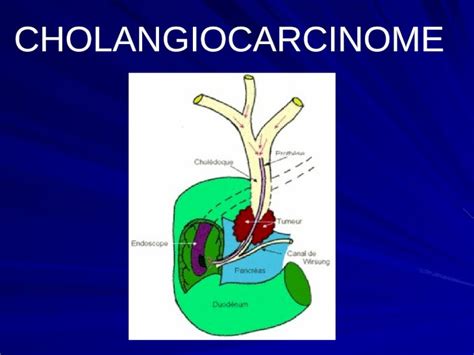 Ppt Cholangiocarcinome Les Kystes Du Cholédoque La Maladie De
