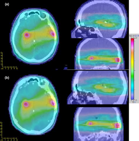 Dose Distribution Of A Clinical Vmat Plan Calculated On Planning A Download Scientific