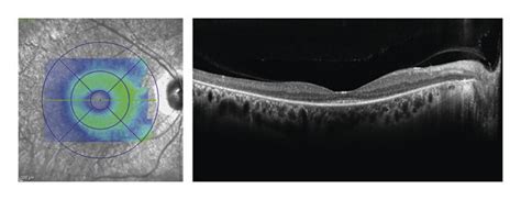 Spectral Domain Optical Coherence Tomography Registration Thickness Download Scientific Diagram