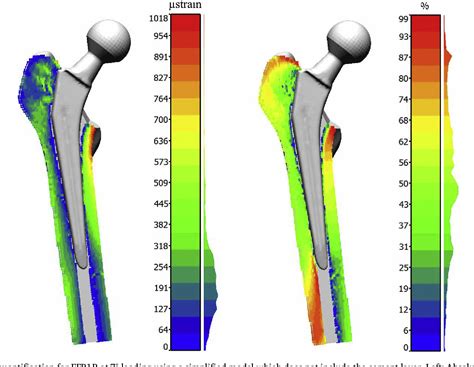 Figure 1 From Patient‐specific Finite Element Analysis Of Femurs With