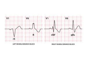 Bundle Branch Blocks Part 1 Left And Right Bundle Branch Blocks Medical Exam Prep