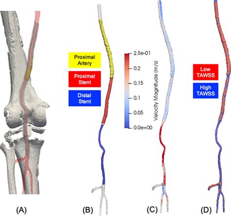 Popliteal Artery Stent