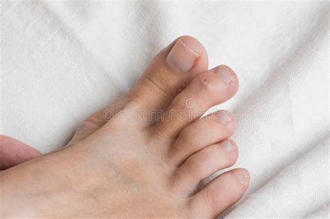 Calluses On Female Fingers Close Up The Problem Of Uncomfortable Shoes Stock Image Image Of
