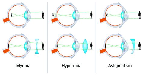 Refractive Error Lotag Eye Clinic