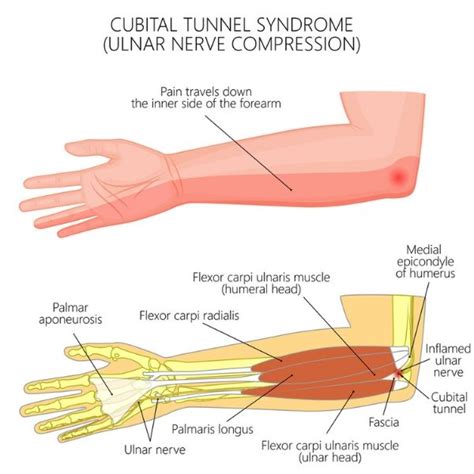 Radial An Ulnar Nerve Motor Testing Protocol