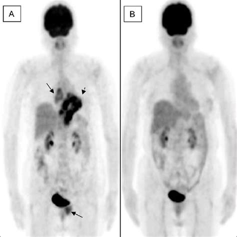 Contour Maps For Estimating The Risk Of Gist Recurrence After Surgery Download Scientific
