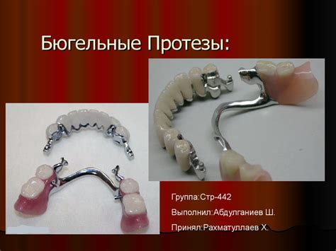 Бюгельные протезы презентация онлайн