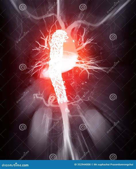 Cta Whole Aorta With Aortic Stent A Clear Visualization Of The Aorta