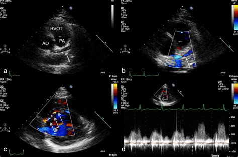Imaging Results Of A 23 Year Old Female Patient With Alcapa A Higher Download Scientific