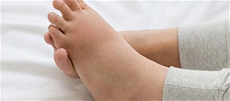 3 Symptoms Of High Uric Acid Signs