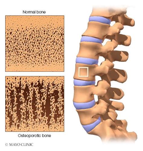 Mayo Clinic Q And A Who Should Have A Bone Density Test Mayo Clinic