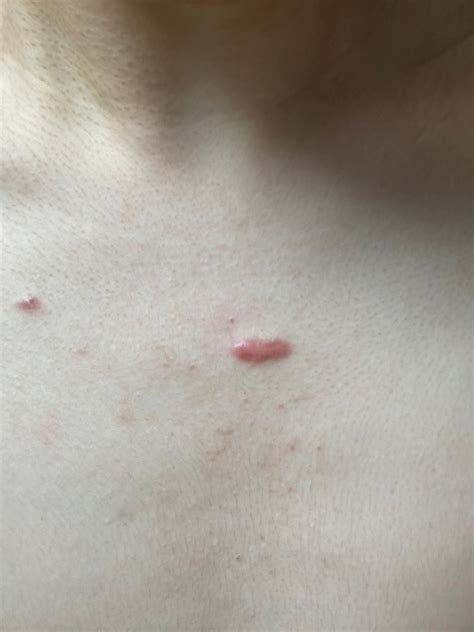 가슴 여드름 염증인지 무엇인지 구별이안가요 지식in