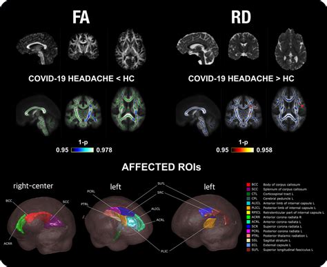 Tbss Results Of The Diffusion Descriptors That Showed Statistically Download Scientific Diagram
