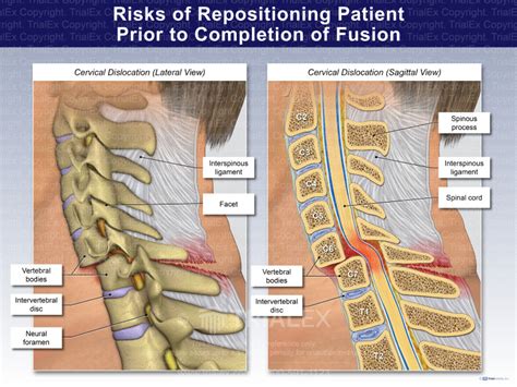 Risks Of Repositioning Patient Prior To Completion Of Fusion Tr