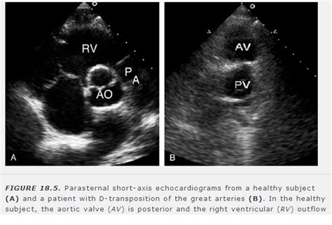 Cardiology ABNORMALITIES OF RIGHT VENTRICULAR INFLOW