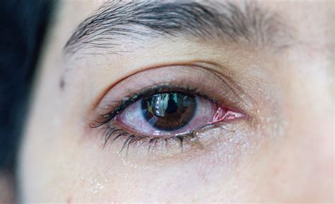 Uveitis Or Pink Eye Icr