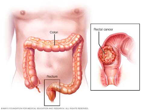 What Is Rectal Cancer Medicine For World