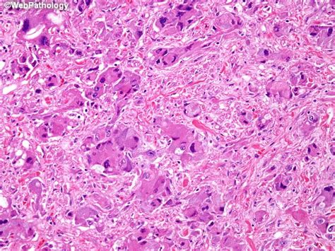Pheochromocytoma Surgical Treatment Pheochromocytoma Surgical Treatment