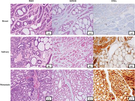 Immunohistochemistry Staining For Sox10 And Ema In Adenoid Cystic