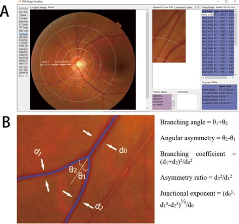 A Retinal Vascular Geometric Variables Assessed Quantitatively By The Download Scientific