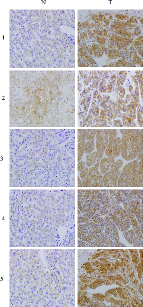 Numb Expression Level Up Regulated In The Primary Hcc Tissues Compared