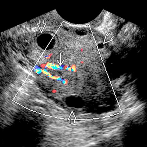 Adnexalovarian Torsion Radiology Key