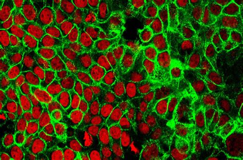 a machine learning tool can help with diagnosing monitoring colorectal