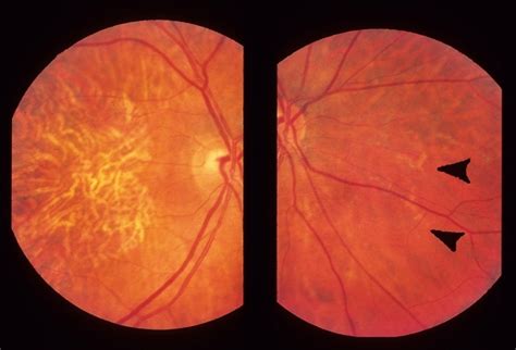 Pattern Dystrophy Retina Image Bank