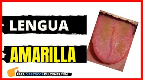 Descubre Por Qué Es Perjudicial Tener La Lengua Amarilla Y Cómo