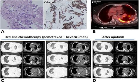 Low Dosage Apatinib As Rescuing Treatment In Advanced Malign