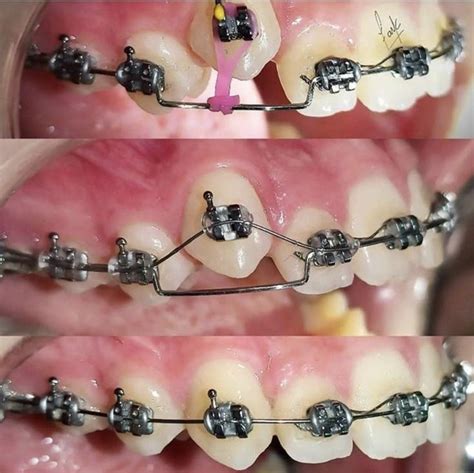 Pin de Ágnes Ximena Hdez Castillo en MUELAS HIGH babe en Ortodoncia brackets