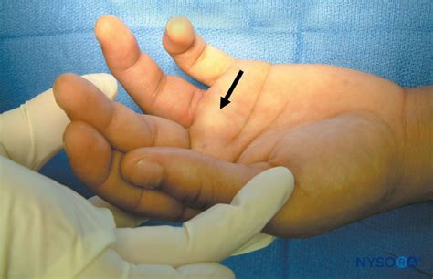 Digital Block Landmarks And Nerve Stimulator Technique Nysora Nysora