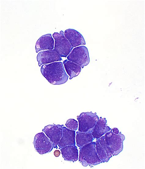 Malignant Cells In Csf