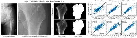 Figure 1 From Bone Mineral Density Estimation From A Plain X Ray Image By Learning Decomposition