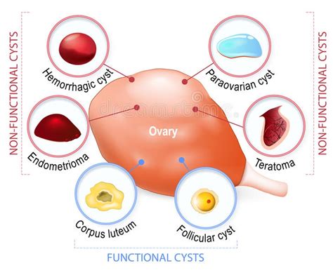 Types Of Ovarian Cysts Ultrasound