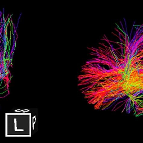 Tracts With Significant Group Specific Effects Of Wm Microstructure