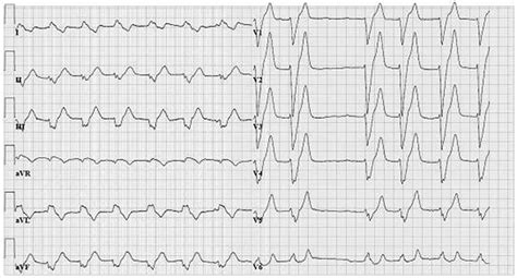 Atrial Fibrillation And Left Bundle Branch Block Download Scientific