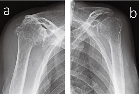 A Preoperative Plain X Ray Of Case 2 A Right Shoulder Joint Larsen