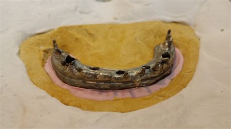Fixed Detachable Dentures Maclarty Dental Laboratory