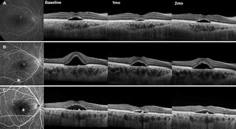 Representative Three Cases With Acute Csc Treated With Intravitreal