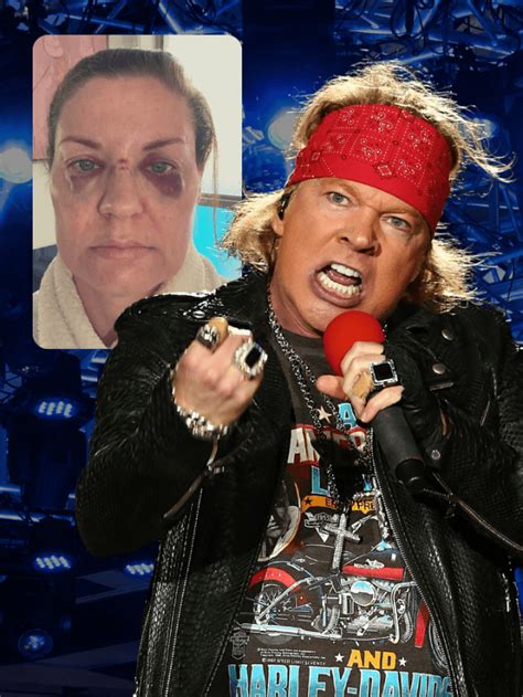 ‘blood Everywhere Woman Struck By Axl Roses Microphone The Advertiser