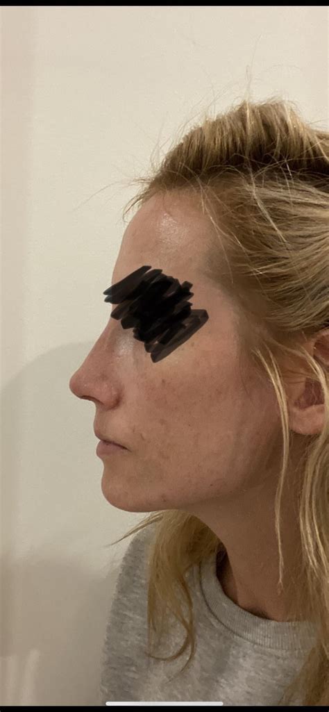 5 Weeks Post Op Septorhinoplasty And Turbinoplasty Rplasticsurgery
