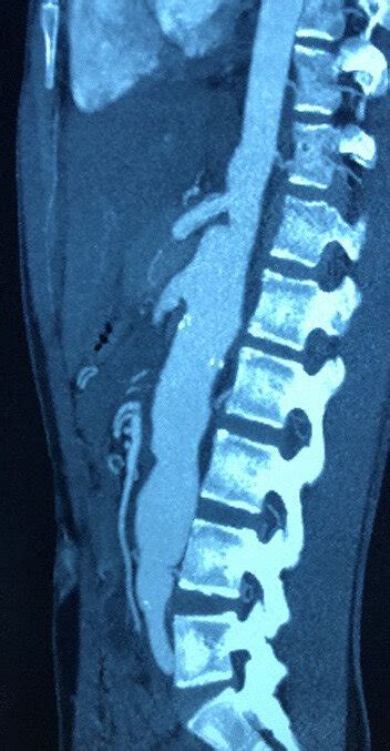 Computed Tomography Angiography Showing Diffuse Artery Thickening With Download Scientific