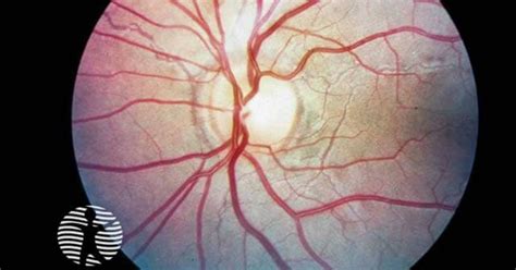 Pseudoxanthoma Elasticum Image