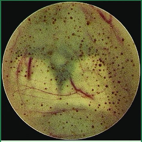 Endoscopic View Of Petechial Hemorrhages Along The Arachnoid And Download Scientific Diagram