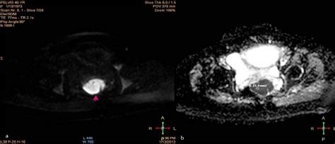 A Diffusion Weighted Images Show Restricted Diffusion In The Upper