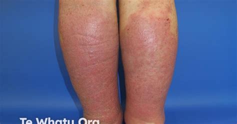 Acute Lipodermatosclerosis Image